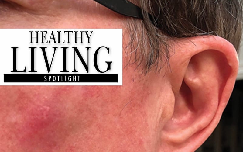 Holiday rashes and dry skin during the winter months | Navarre Press